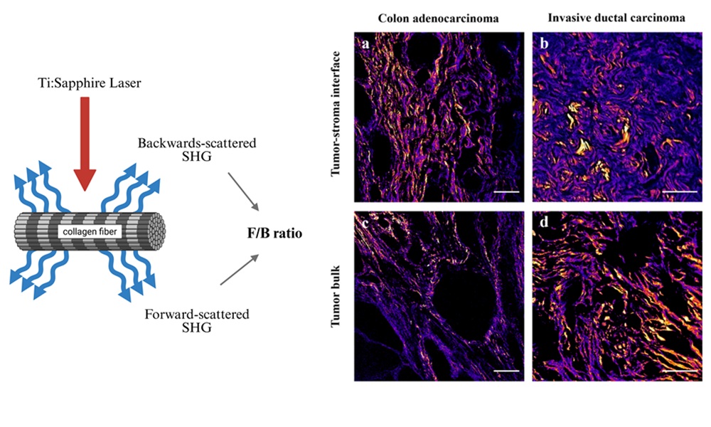 Racial differences in tumor collagen structure may impact cancer prognosis