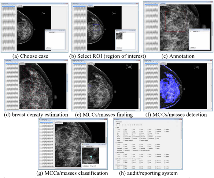 Computer Aided Design System Aids Mammography Screening